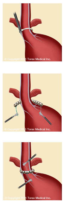 LINX Procedure - Stamford HealthHeartburn, Reflux, and Esophageal Center